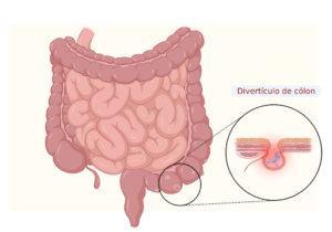 O que são os divertículos no cólon? - Dr. Francisco Tustumi