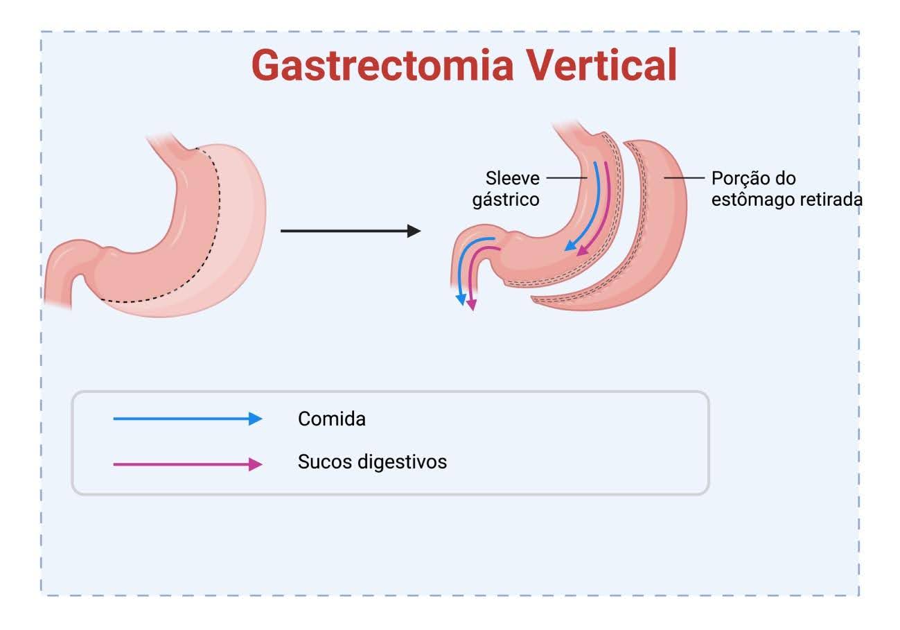 Gastrectomia vertical: o que é e como é feita essa cirurgia bariátrica ...