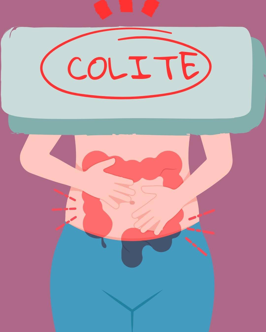 Colite: O que é, causas, sintomas e tratamento - Dr. Francisco Tustumi