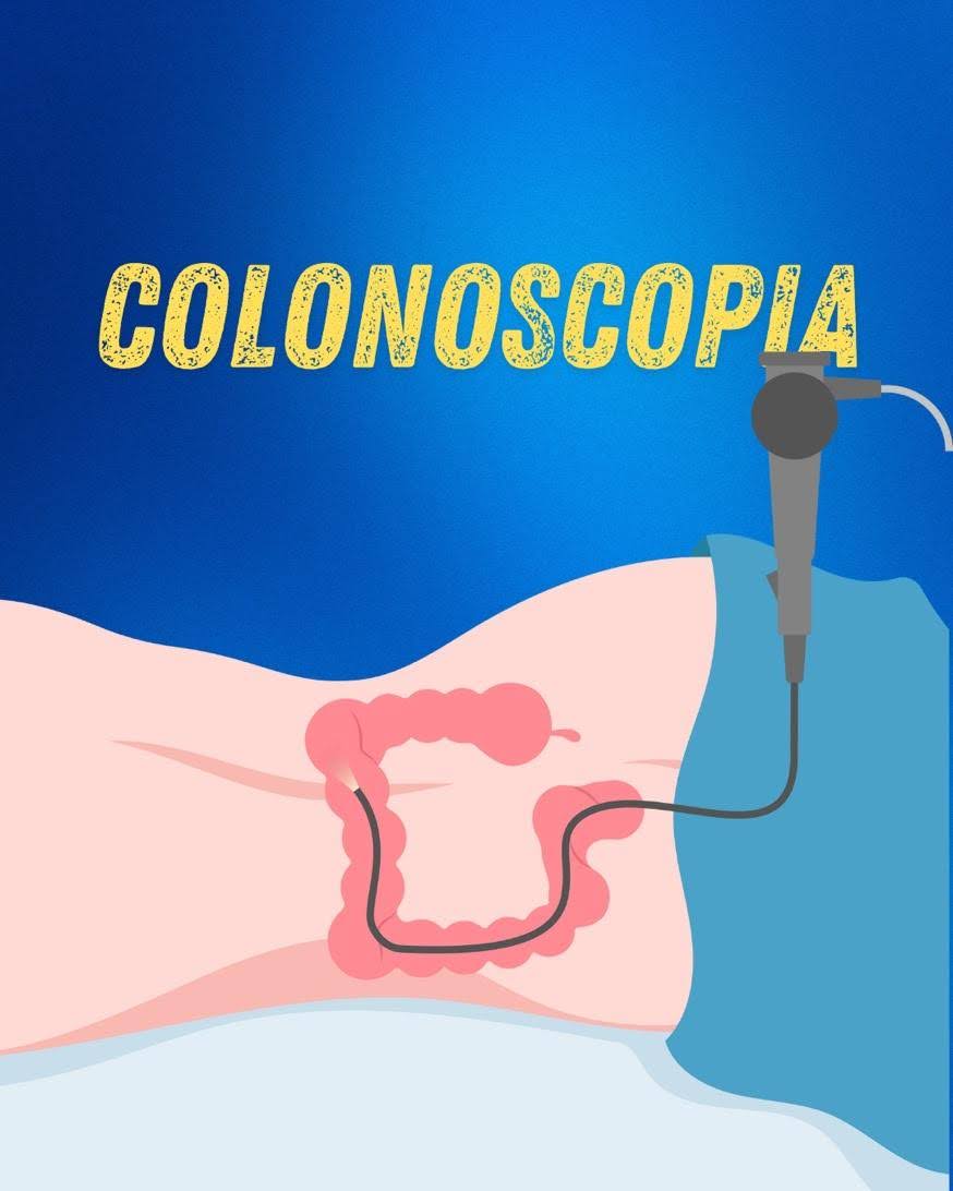 Colonoscopia: o que é e como é feito o preparo? - Dr. Francisco Tustumi